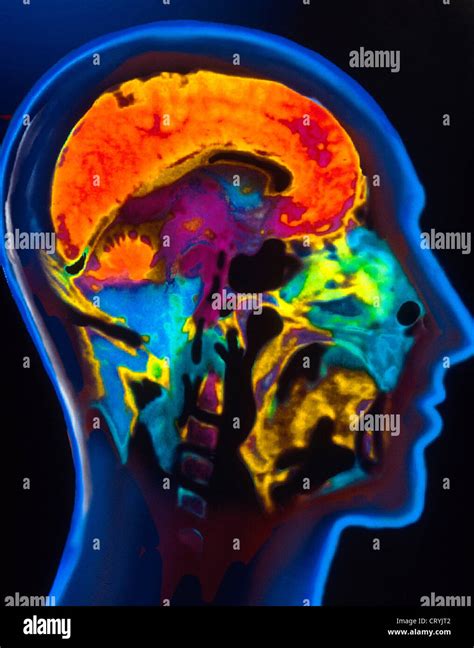 Mri Scan Des Normalen Gehirns Fotos Und Bildmaterial In Hoher