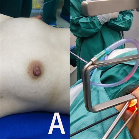 Endoscopic Thyroidectomy Through Non Inflatable Axillary Approach A Download Scientific