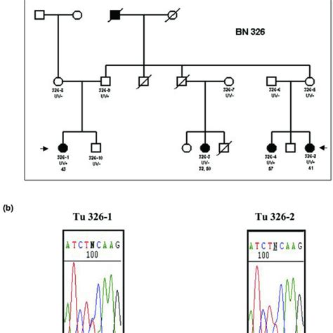 Segregation And Loss Of Heterozygosity Analysis Of The S384f Variant Download Scientific