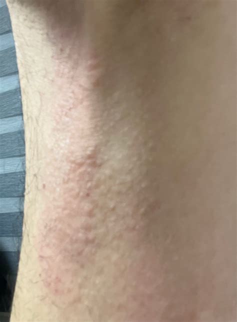 허벅지 뒤쪽 피부발진 염증 지식in