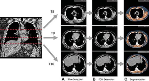 AI Predicts Mortality Risk Using Lung CT Data Applied Radiology