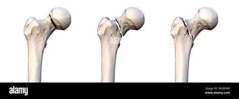 Illustration Of Femur Neck Fracture Types Subcapital Transcervical And Basicervical Stock