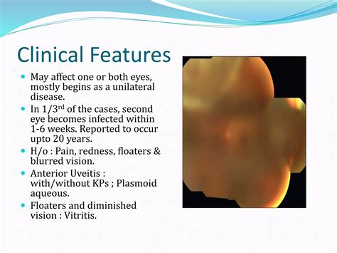Acute Retinal Necrosis Ppt