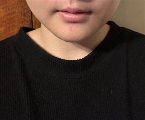 시술수술 질문 입술필러 맞아보신분 강남언니 1등 성형수술and피부시술 정보앱