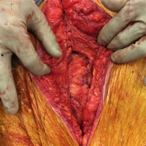 Reduction Of Hernia Content And Primary Closure Of The Defect Download Scientific Diagram