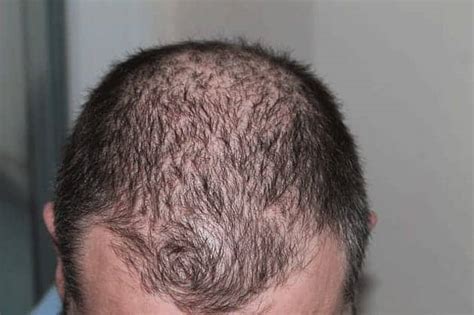 How To Stop Hair Loss For Men And Women Aesthetics Hair Transplant
