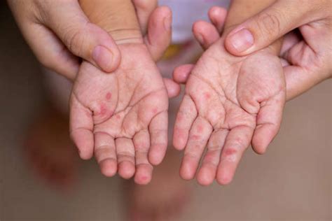 Why Enterovirus D68 Is On The Rise