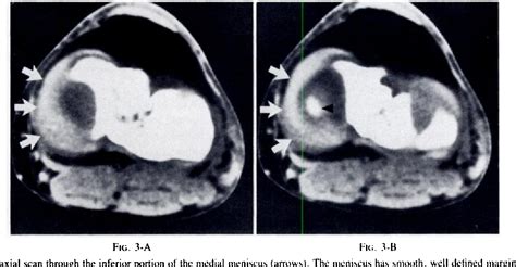 Figure 3 From Prediction Of The Angle Of Gibbus Deformity In Tuberculosis Of The Spine