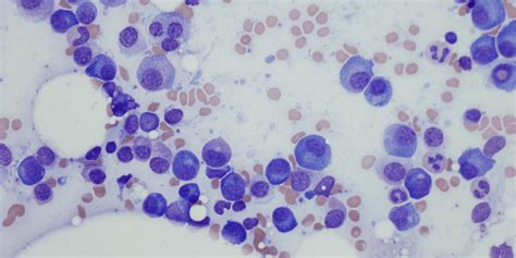 Study Uncovers Nk Cell Based Combination Immunotherapies For Multiple