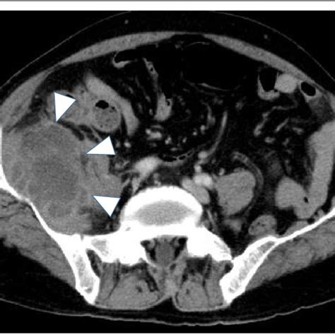 Ct Image Enhanced Computed Tomography Revealed A Heterogeneous