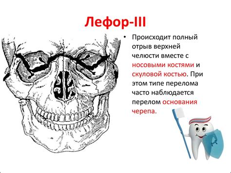 Переломы верхней челюсти у детей презентация онлайн
