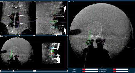 The Use Of A Spine Surgery Robot In Orthopedics Perlove
