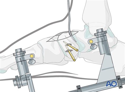 Lag Screw Of Simple Complete Navicular Fracture