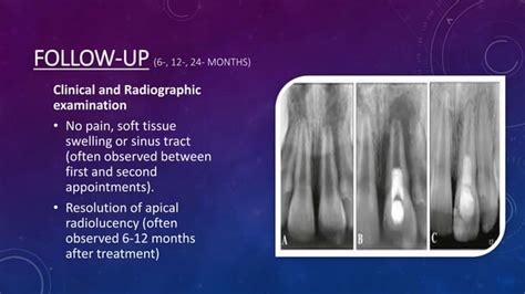 Pulp Revascularizationpptx