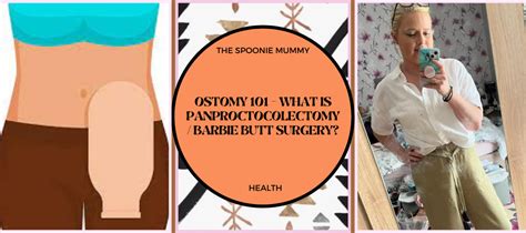 Ostomy 101 What Is Panproctocolectomybarbie Butt Surgery The