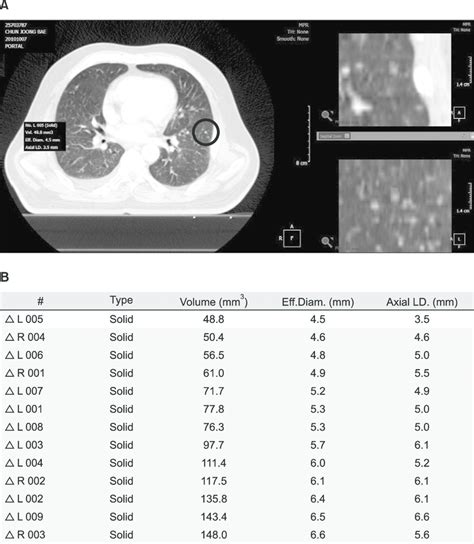 Example Of Detection Of A Pulmonary Nodule On A Computed Tomography