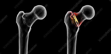 Basicervical Femur Fracture Illustration Stock Image F043 9280 Science Photo Library