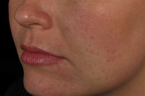 Breakouts And Acne Results Environ Skin Care