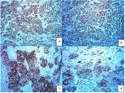 A Endometrial Stroma Infiltration Hematoxylin And Eosinx200 B Download Scientific Diagram
