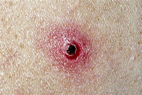 Cat Scratch Fever Symptoms And Treatment Lovetoknow