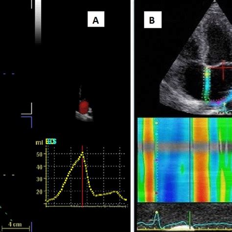 A Assessment Of Left Atrial Volume With 3d Atrial Volume Analysis B 2d