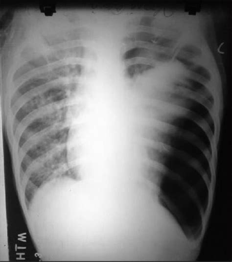 Unusual Presentation Of Pulmonary Nocardiosis As Pyopneumothorax In Hiv Pmc