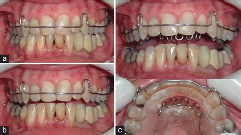 Class 2 Elastics Side Effects At Benjamin Hutchison Blog