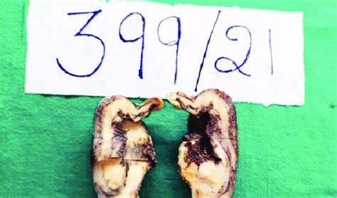 Cut Section Of Testis Showing Variegated Appearance With Specks Of