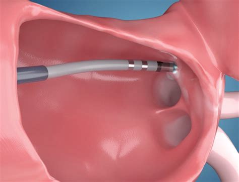 Medtronics Diamondtemp Ablation System Receives Fda Approval For Atrial Fibrillation Surgmedia