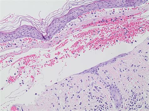Pemphigoid Histology