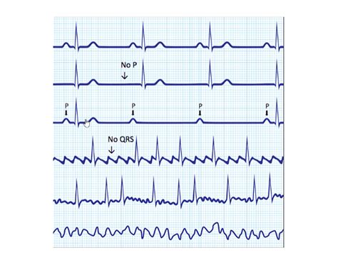 Ekg Patterns Quiz