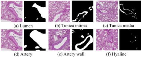 논문 리뷰 Towards Fine Grained Renal Vasculature Segmentation Full Scale Hierarchical Learning