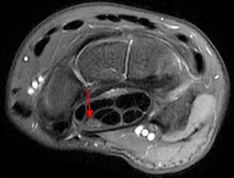Persistent Median Artery Radsource