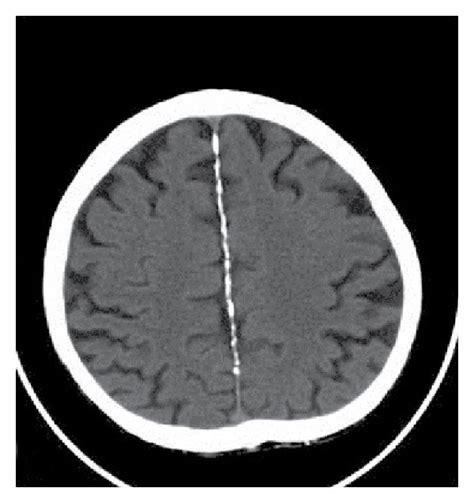 Ct Imaging Of Brain A Calcifications At Tentorium And Mass At