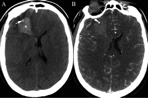 Choroid Plexus Calcification Semantic Scholar