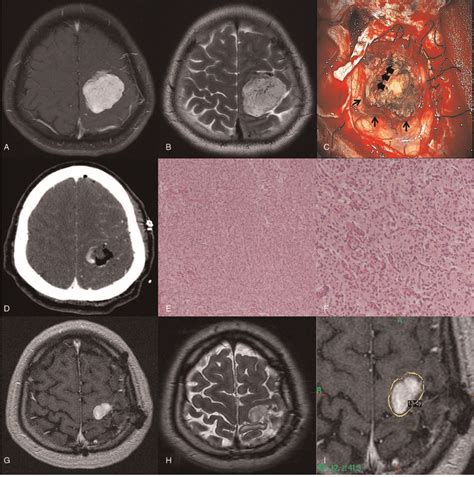 Contrast Enhanced Brain Mri Showed A 47 Cm Sized Heterogeneously