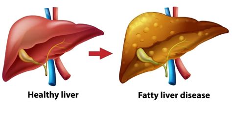 Steatotic Liver Disease Symptoms Risk Factors And Prevention Of Non
