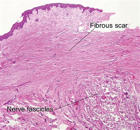 Neural Tumors Clinical Tree