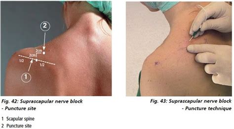 Suprascapular Nerve Block According To Meier Klinik