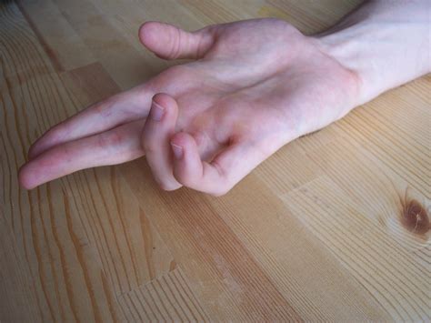 Distortions Of The Hand Claw Hand Msk Medbullets Step 1