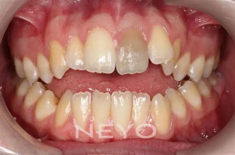 Open Bite NEYO Dental Dental Clinic West Sussex