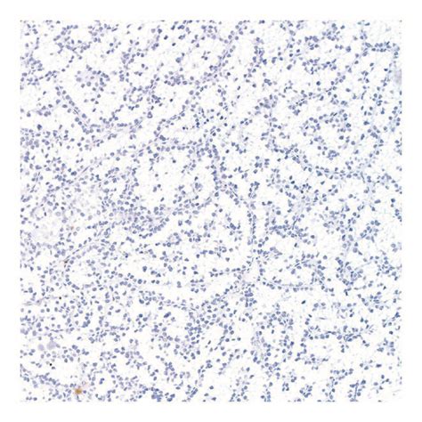 A Thyroglobulin Stain Negative B Focally Weakly Positive