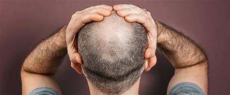 The Truth About Genetics And Male Pattern Baldness