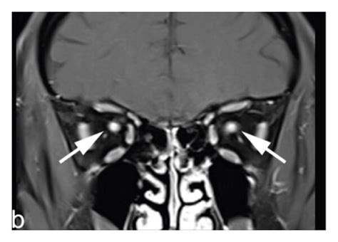 Mri Identified Optic Nerve Lesions In Patients With Methanol Induced Download Scientific
