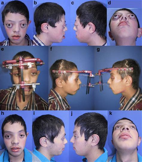 Photos Of A Preoperative Frontal View B Preoperative Right Lateral