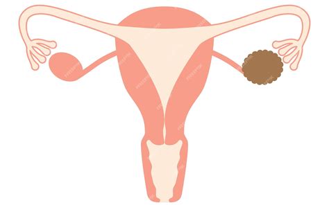 Premium Vector Diagrammatic Illustration Of Ovarian Cysts Anatomy Of