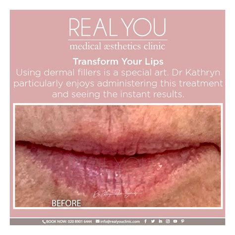Before And After Real You Clinic Twickenham And Richmond