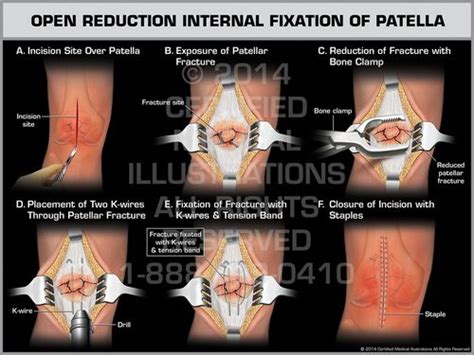Patella Open Reduction Internal Fixation Womantaste
