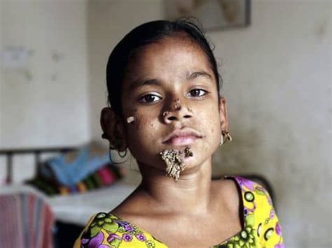 Rare Tree Man Disease May Have Struck First Female Disease Man Tree