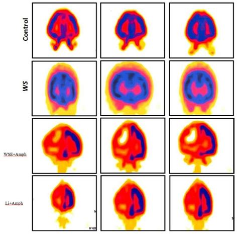 Single Photon Emission Computerized Tomography Spect Imaging The Use